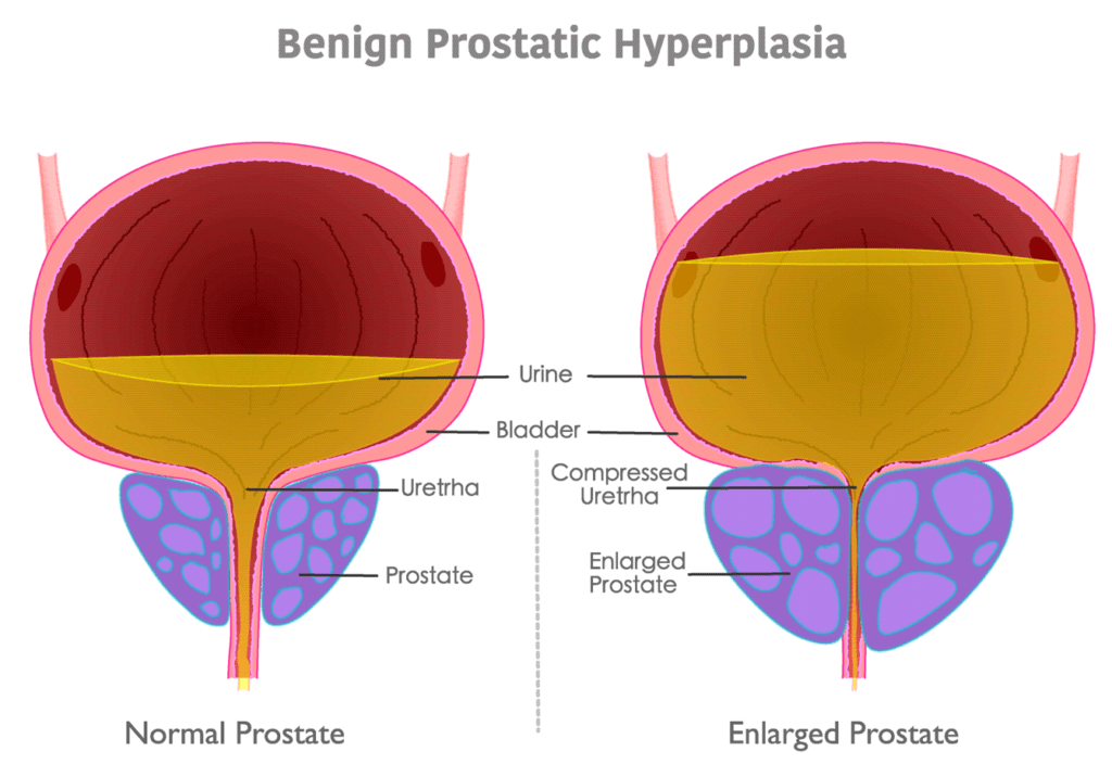 Prostate Artery Embolization - Lowcountry Urology Clinics, PA